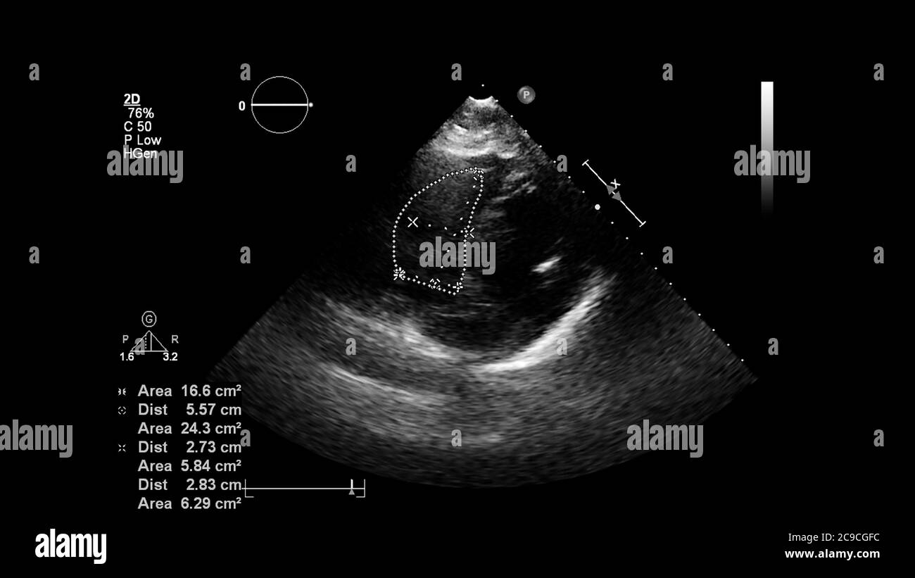 Image of the heart in gray-scale mode during transesophageal ultrasound ...