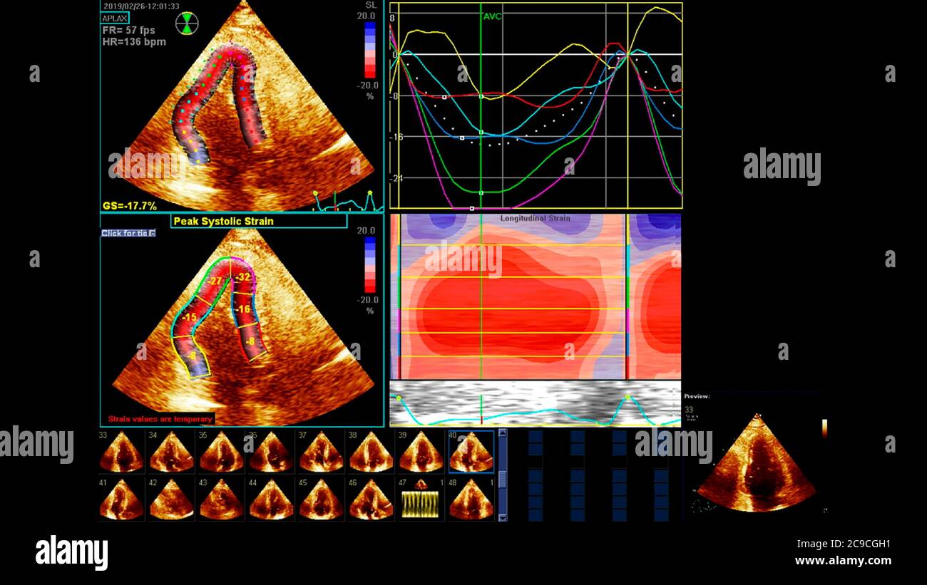 Image of the heart in gray-scale mode during transesophageal ultrasound ...