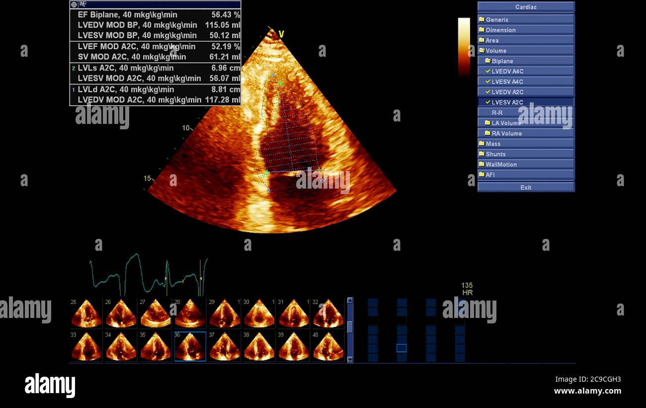 Image of the heart in gray-scale mode during transesophageal ultrasound ...