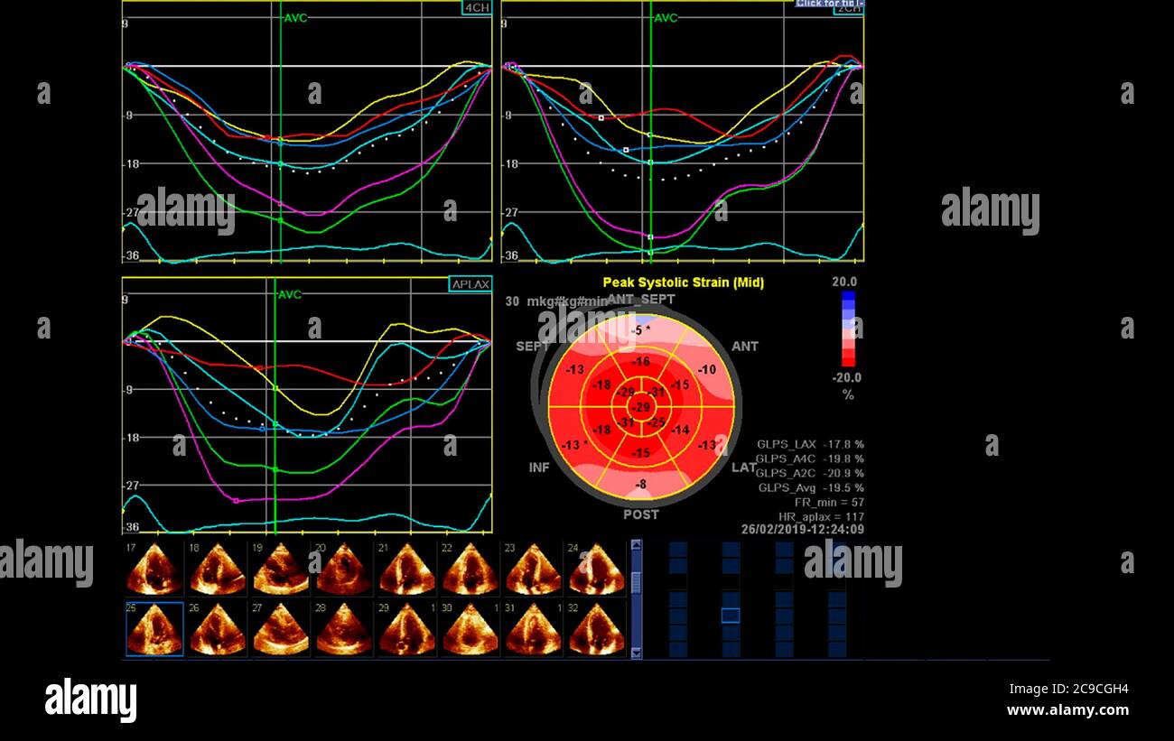 Image of the heart in gray-scale mode during transesophageal ultrasound ...