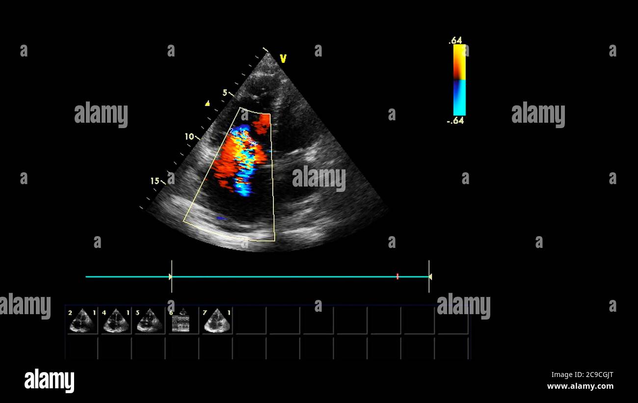 Image of the heart during transesophageal ultrasound with Doppler mode ...