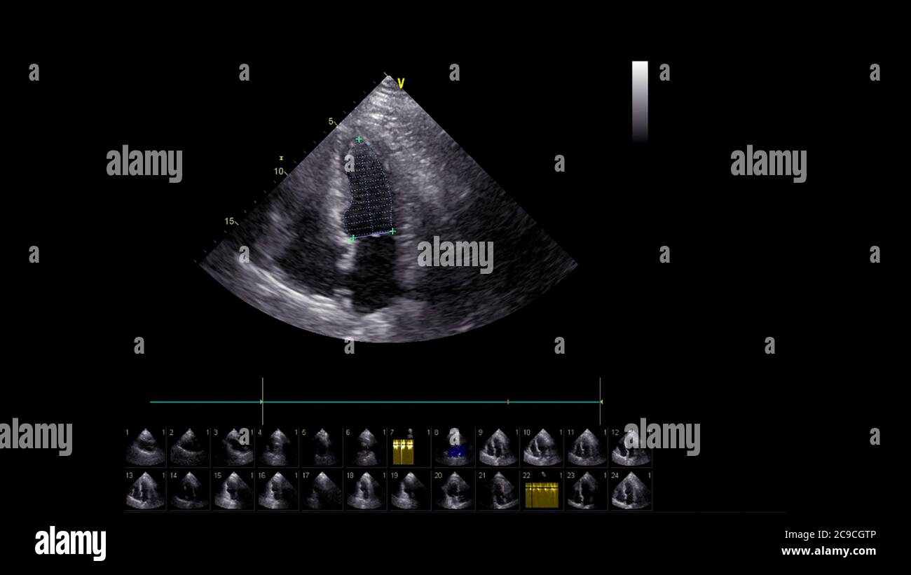 Image of the heart in gray-scale mode during transesophageal ultrasound ...