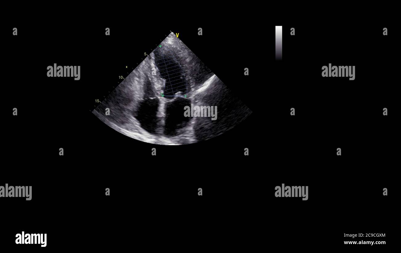 Image of the heart in gray-scale mode during transesophageal ultrasound ...
