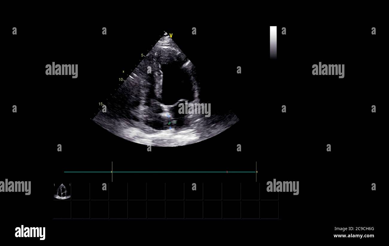 Image of the heart in gray-scale mode during transesophageal ultrasound ...