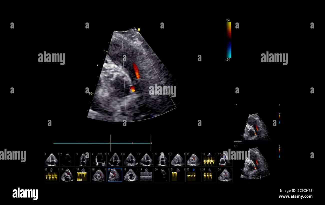 Image of the heart during transesophageal ultrasound with Doppler mode ...
