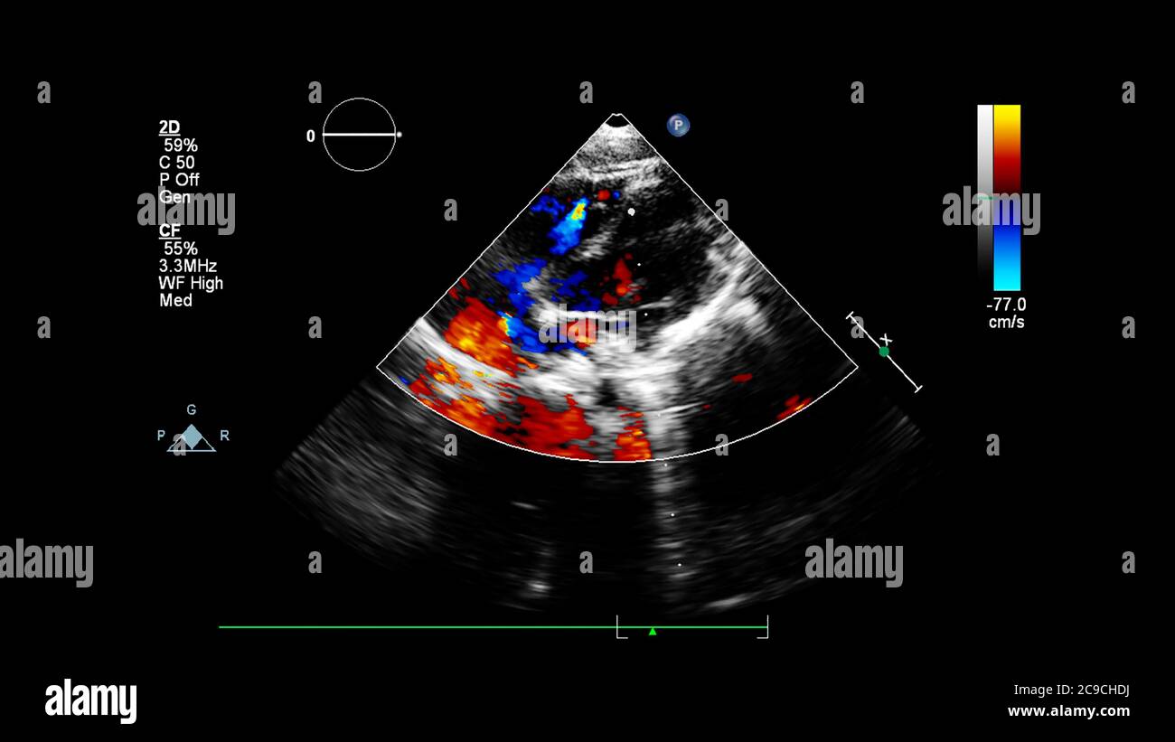 Image of the heart during transesophageal ultrasound with Doppler mode ...