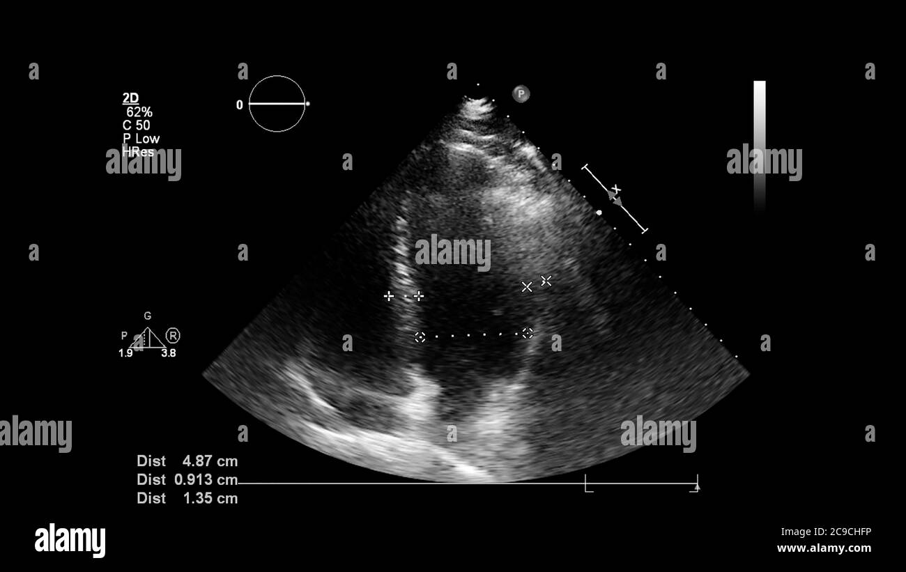 Image of the heart in gray-scale mode during transesophageal ultrasound ...