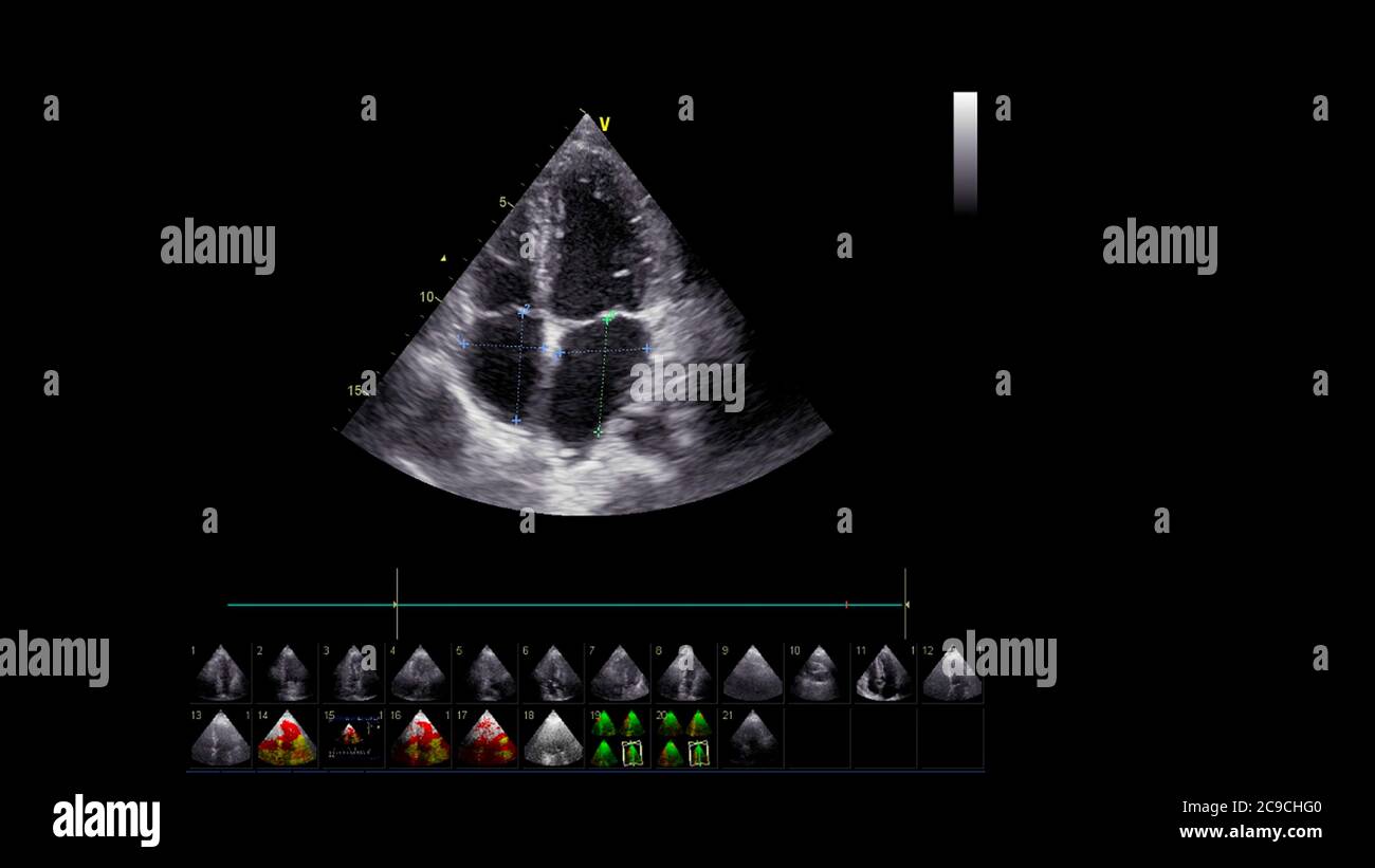 Image of the heart in gray-scale mode during transesophageal ultrasound ...
