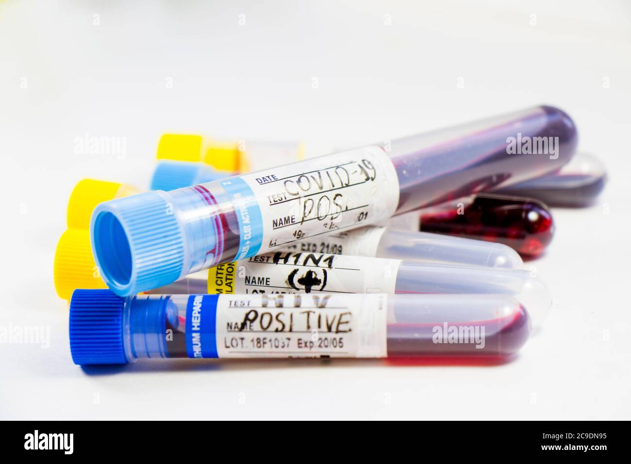 Tuberculosis blood test tube laboratory hi-res stock photography and ...