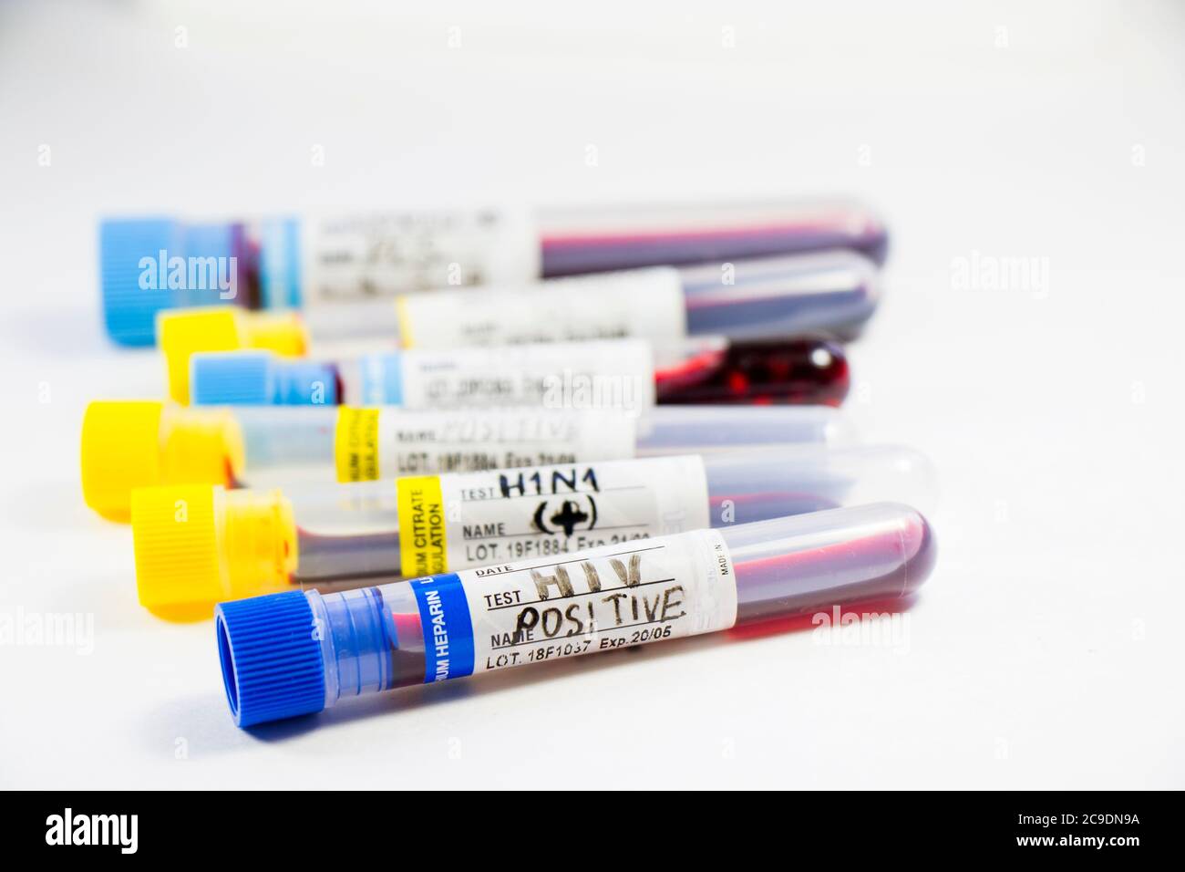 Tuberculosis blood test tube laboratory hi-res stock photography and ...