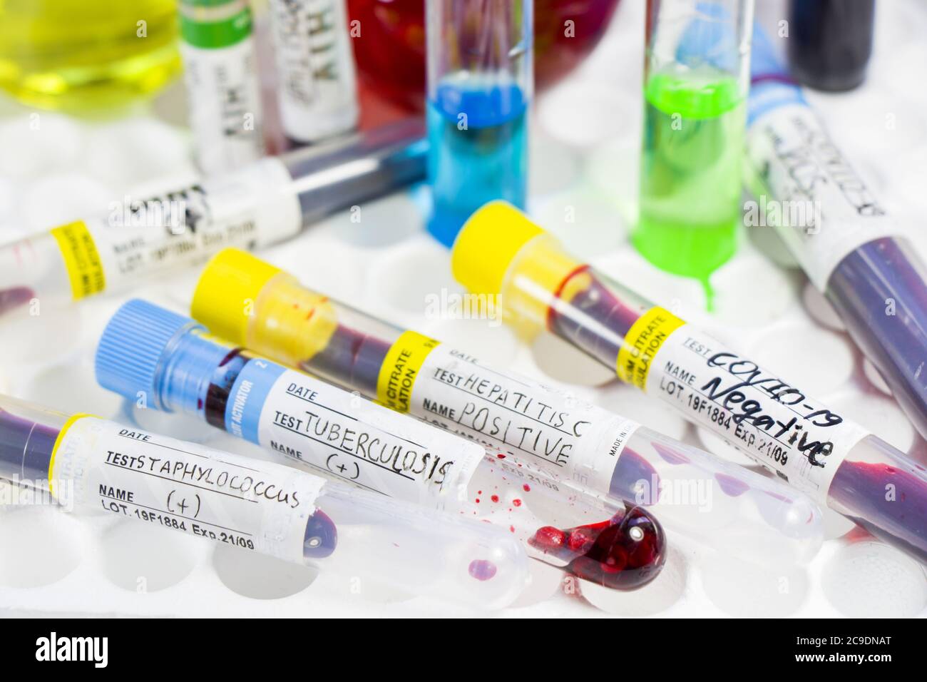 Tuberculosis blood test tube laboratory hi-res stock photography and ...
