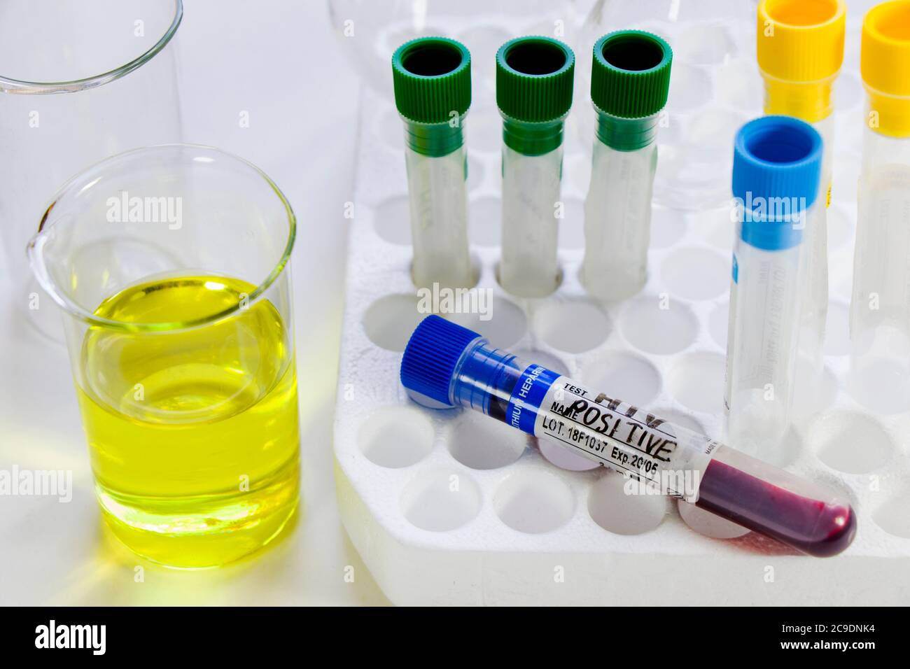 Hiv and aids infection blood test sample, diagnoses and laboratory ...