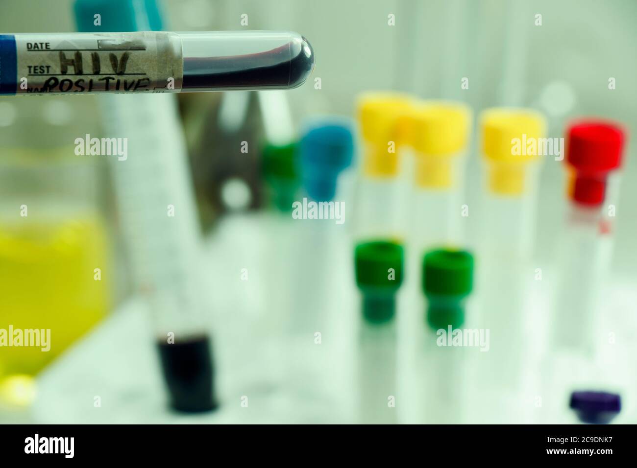 Hiv and aids infection blood test sample, diagnoses and laboratory ...