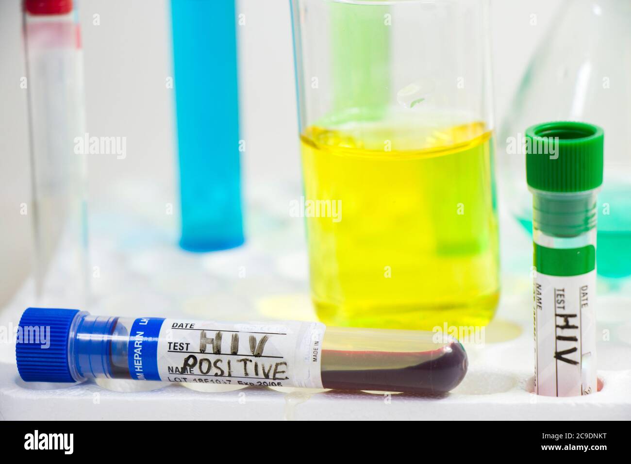 Hiv and aids infection blood test sample, diagnoses and laboratory ...