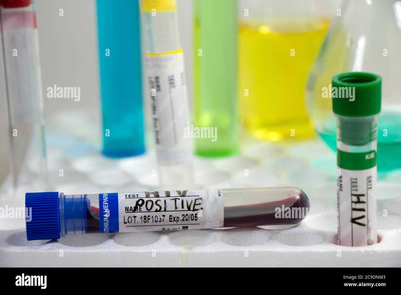 Hiv and aids infection blood test sample, diagnoses and laboratory ...