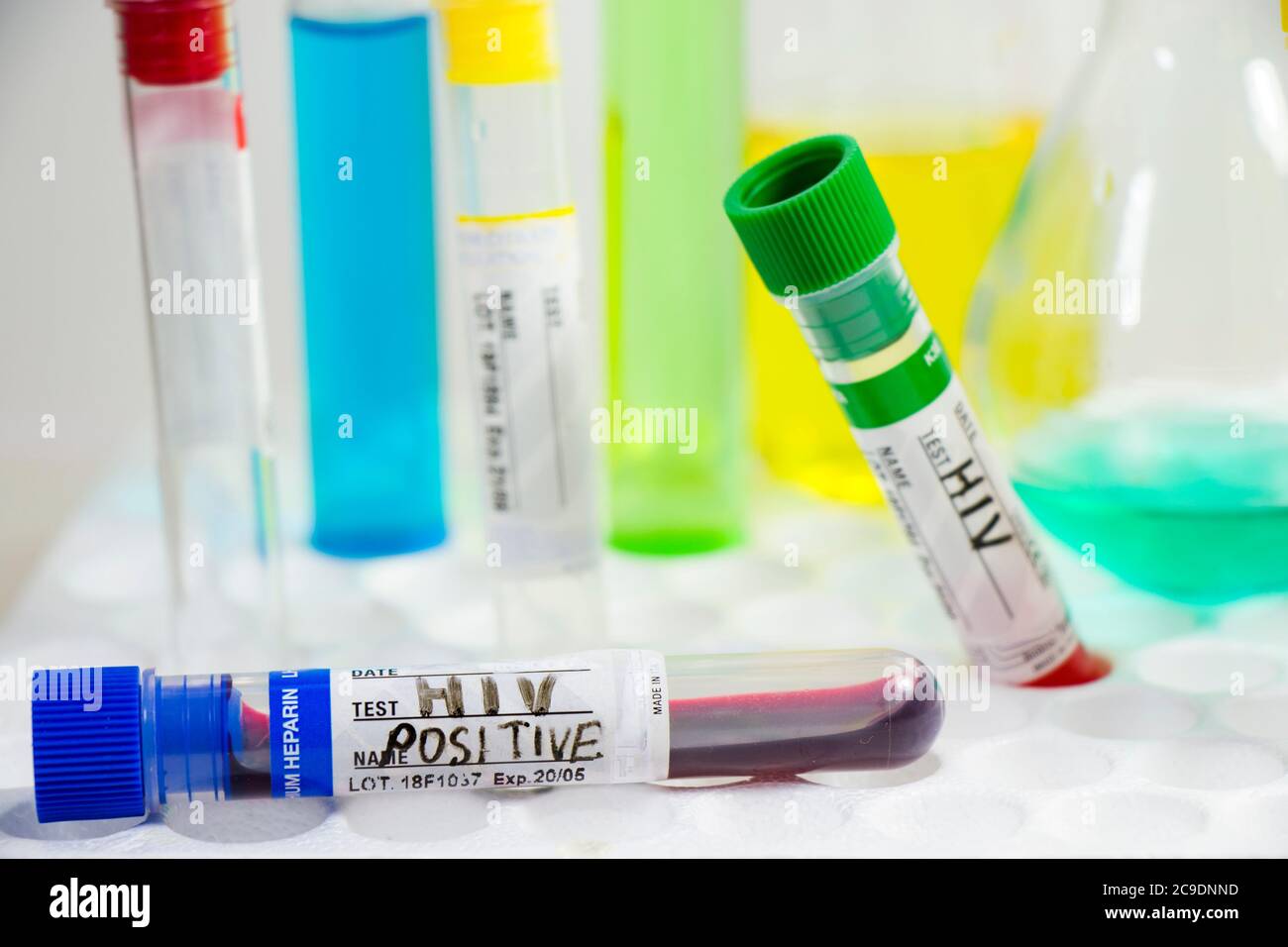 Hiv and aids infection blood test sample, diagnoses and laboratory ...