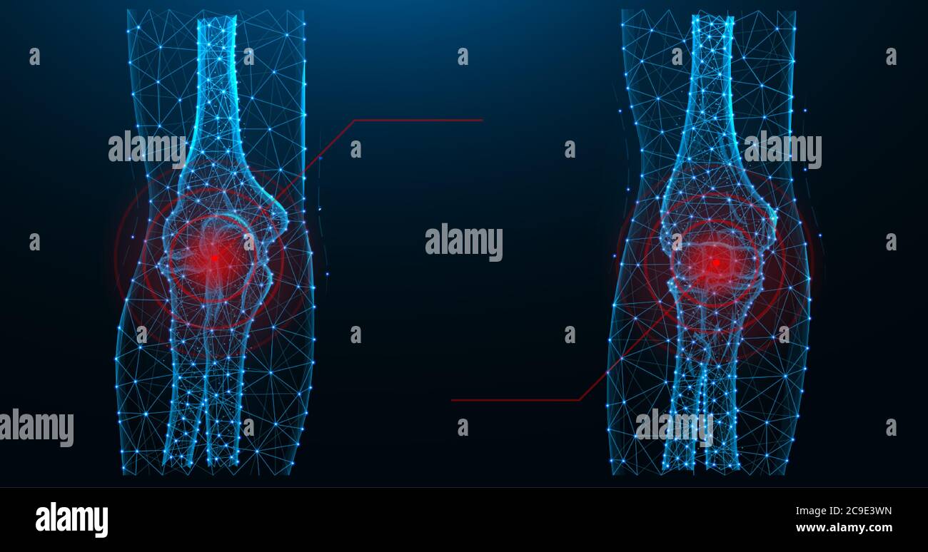 Elbow joint pain blue polygonal vector illustration Stock Vector Image ...