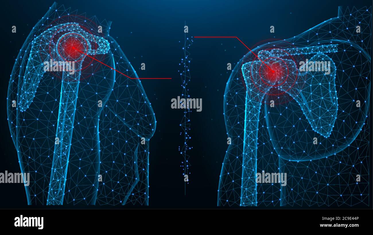 Shoulder joint pain blue polygonal vector illustration Stock Vector ...