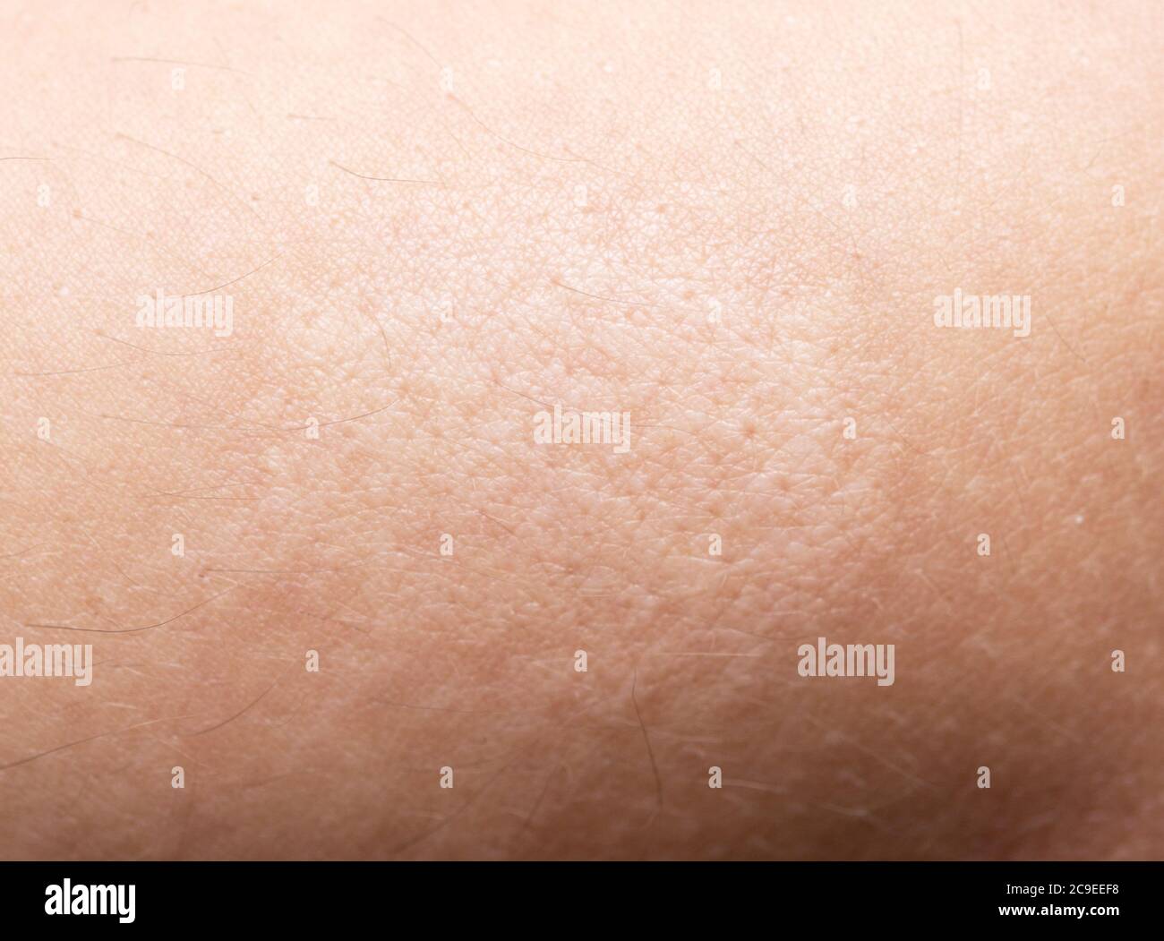 Burn on skin hi-res stock photography and images - Alamy