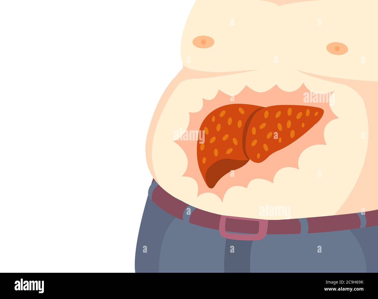 Fatty liver is a group of diseases caused by fat accumulation in the ...