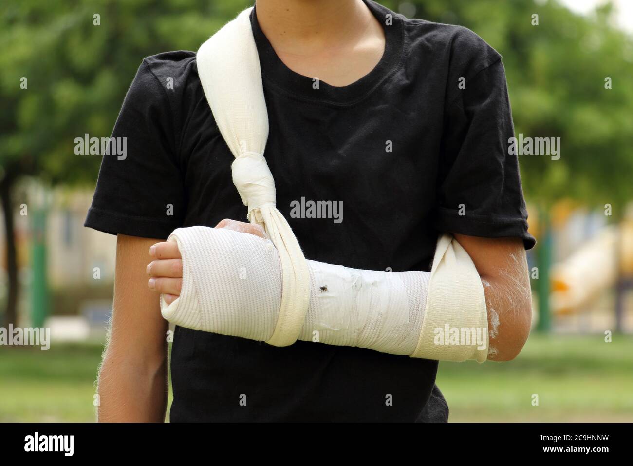 Close up Kid with broken arm and gypsum Stock Photo - Alamy