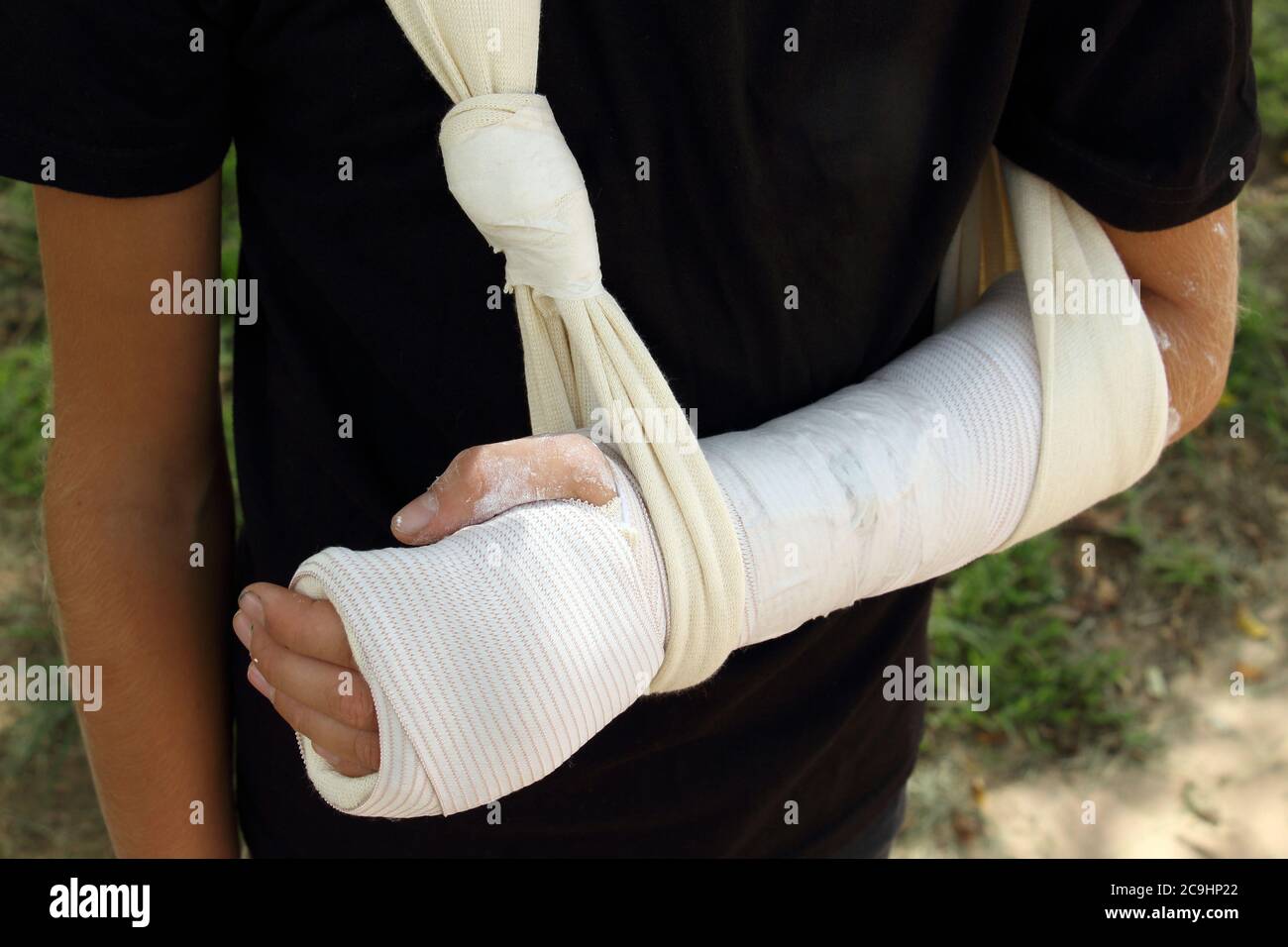 Close Up Kid With Broken Arm And Gypsum Stock Photo Alamy close-up-kid-with-broken-arm-and-gypsum-stock-photo-alamy