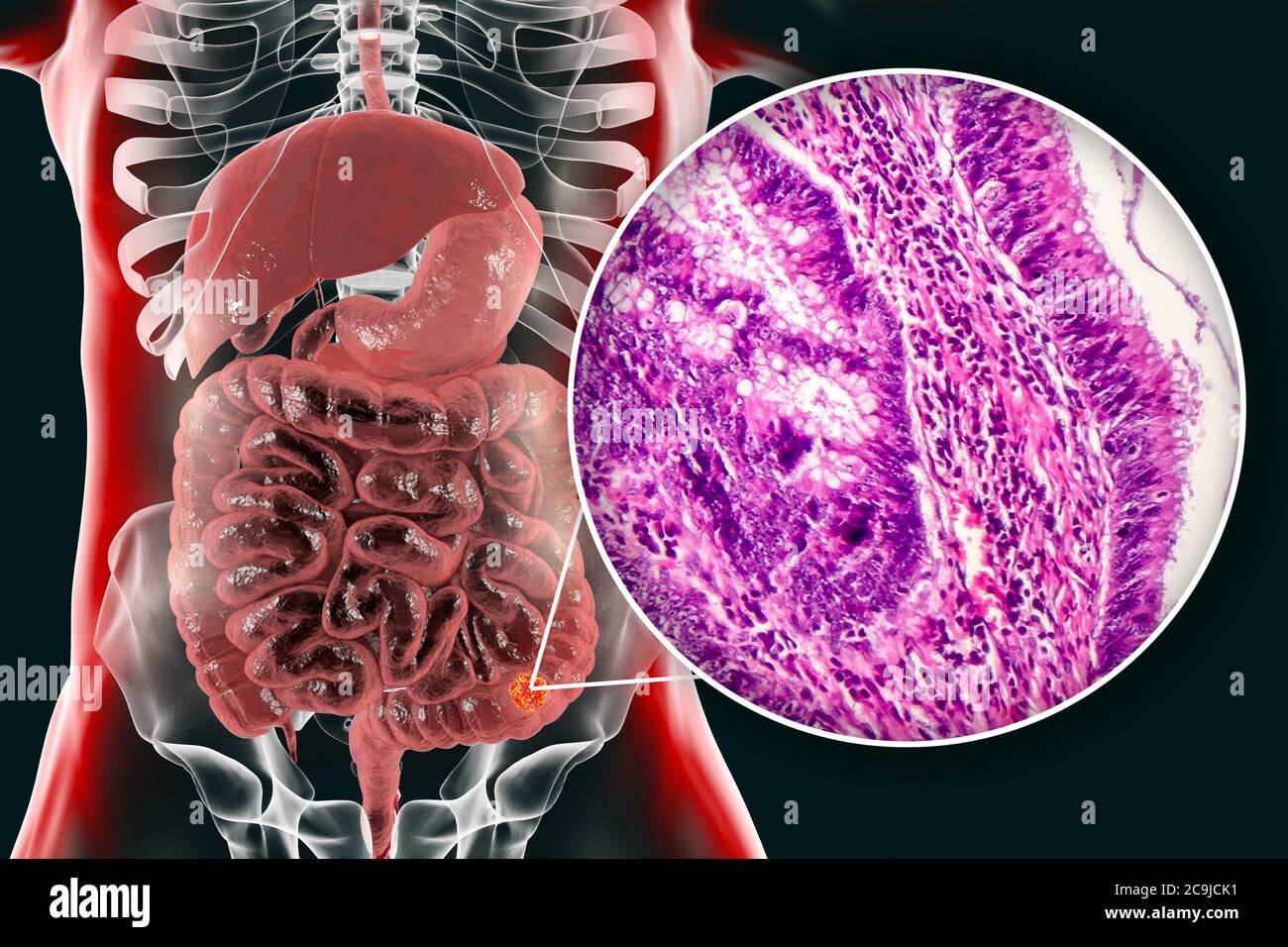 Abnormal colon hi-res stock photography and images - Alamy