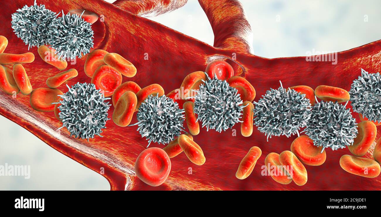 Hairy cell leukaemia. Computer illustration of an abnormal white blood ...