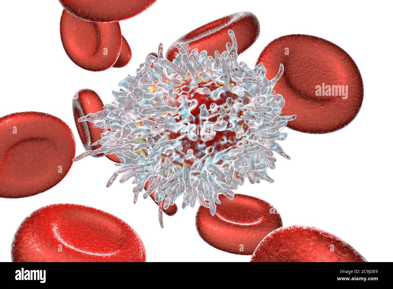 Hairy cell leukaemia. Computer illustration of an abnormal white blood ...
