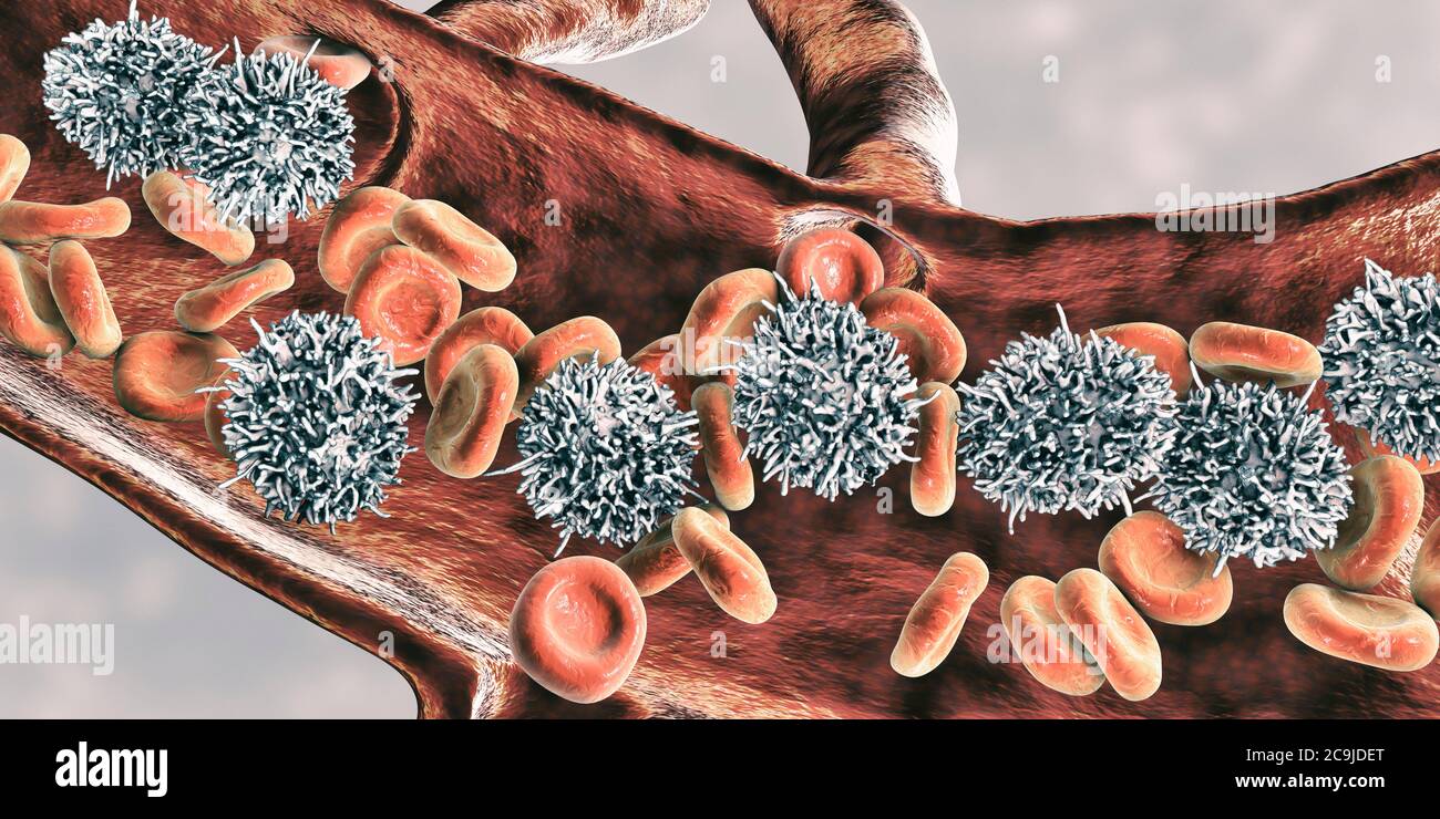 Hairy cell leukaemia. Computer illustration of an abnormal white blood ...