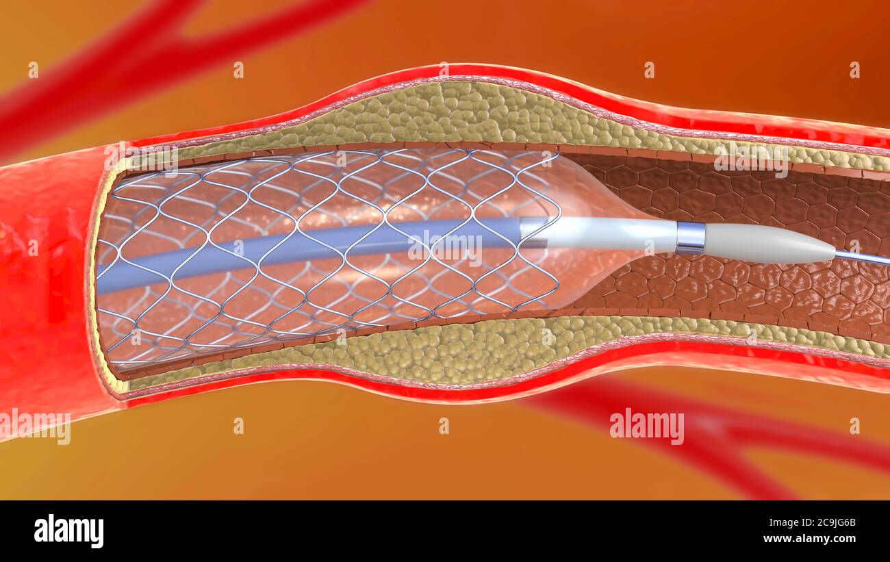 Heart Stent High Resolution Stock Photography and Images - Alamy