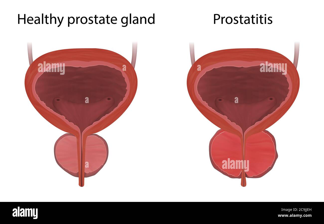 Comparison of prostatitis and a healthy prostate gland, illustration ...