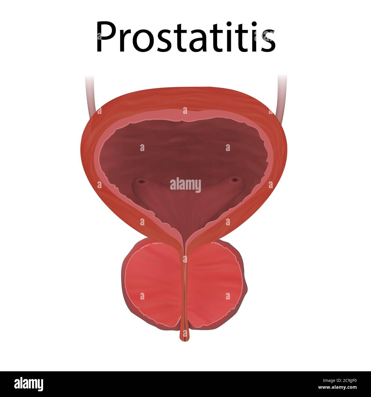 Prostatitis, illustration. Inflammation of the prostate gland Stock ...