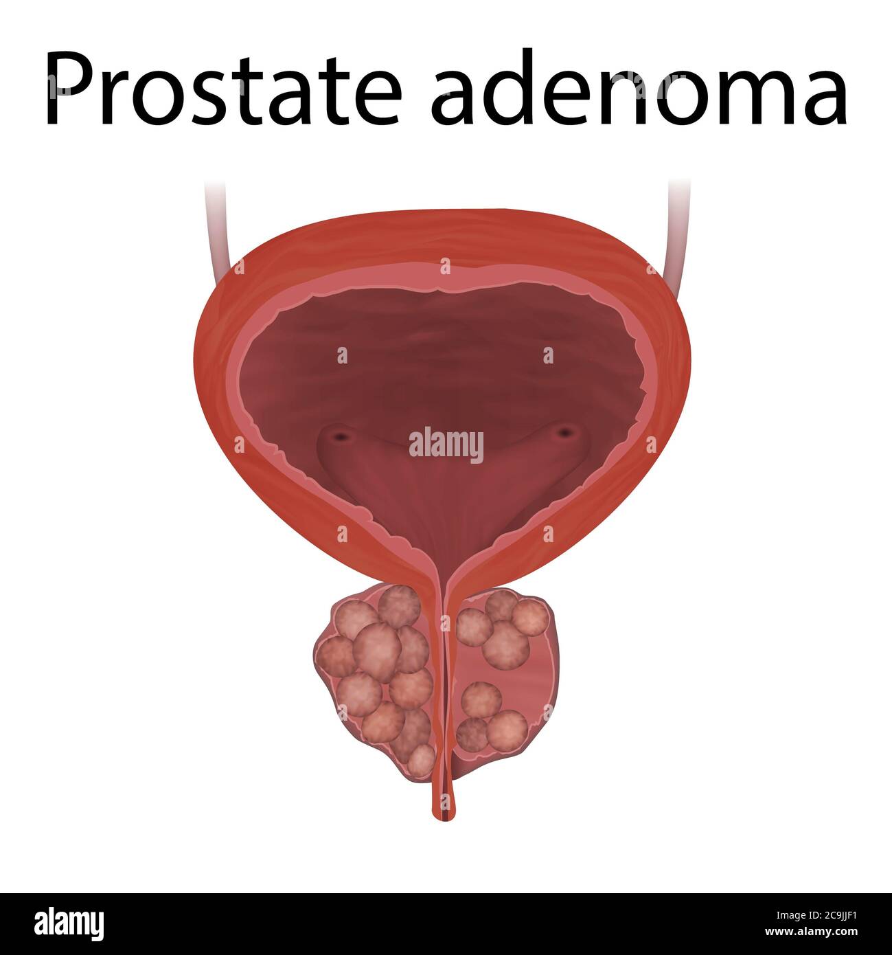 Adenoma of the prostate gland, illustration Stock Photo - Alamy