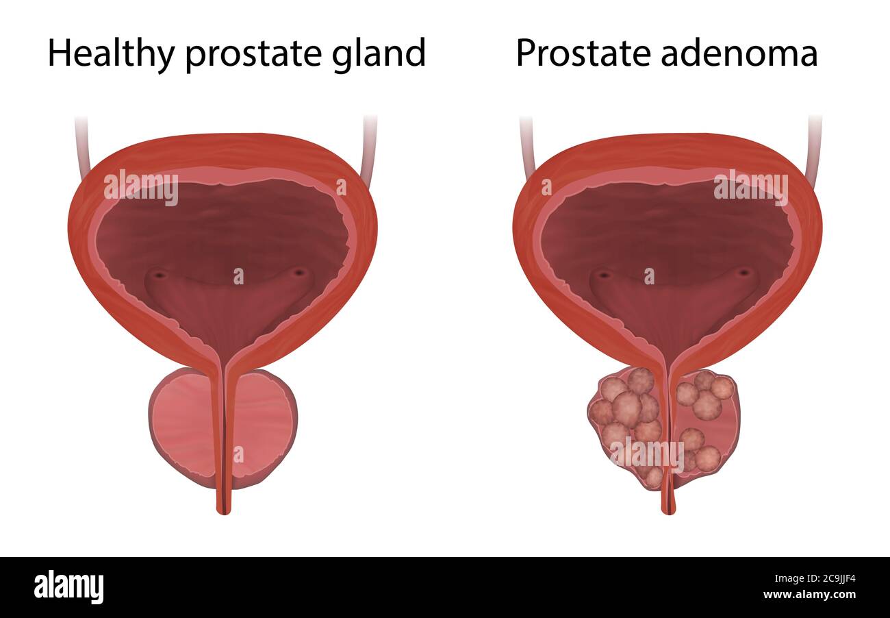 Comparison of prostate adenoma and a healthy prostate gland ...