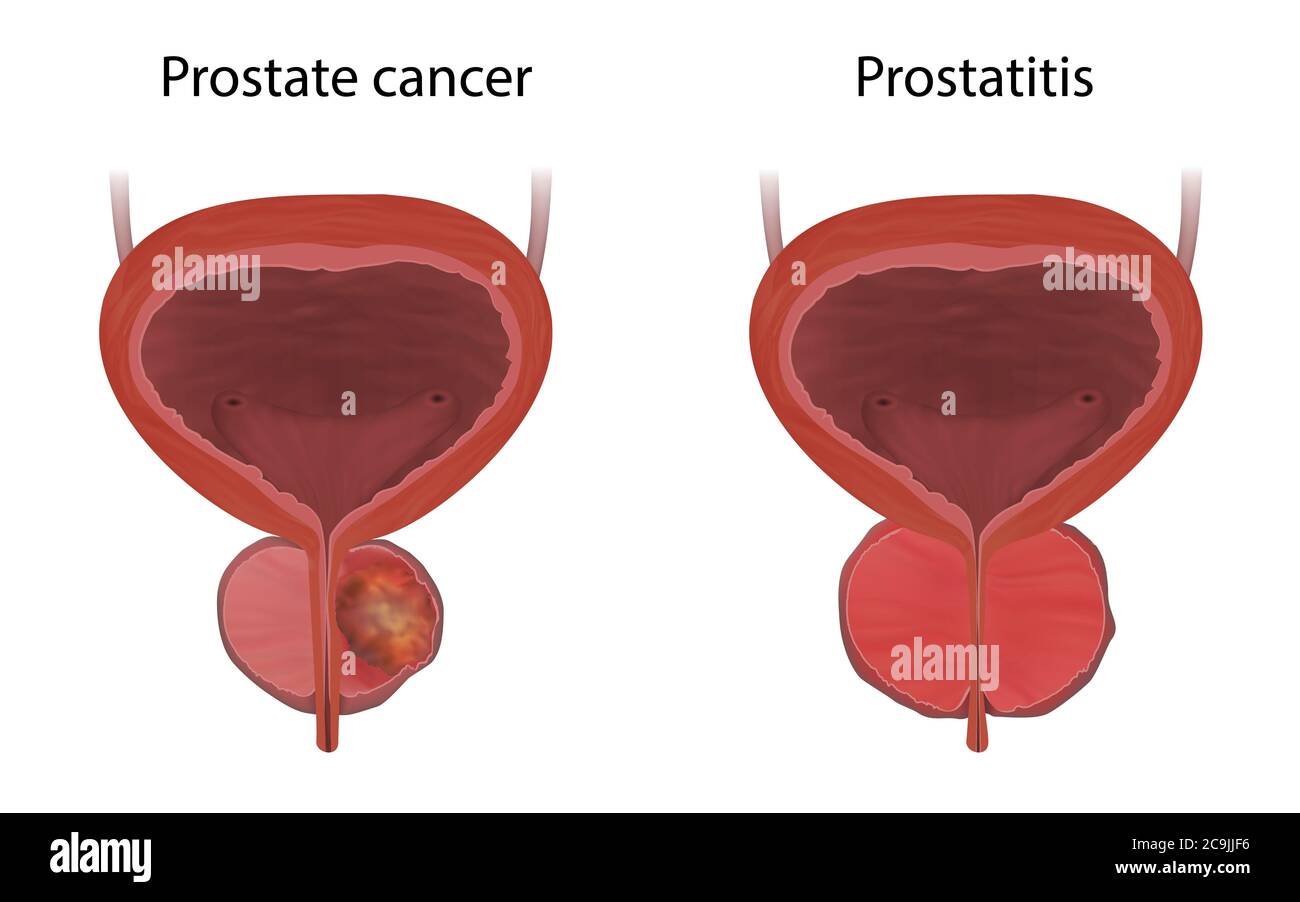 Comparison of prostate cancer and prostatitis, illustration ...