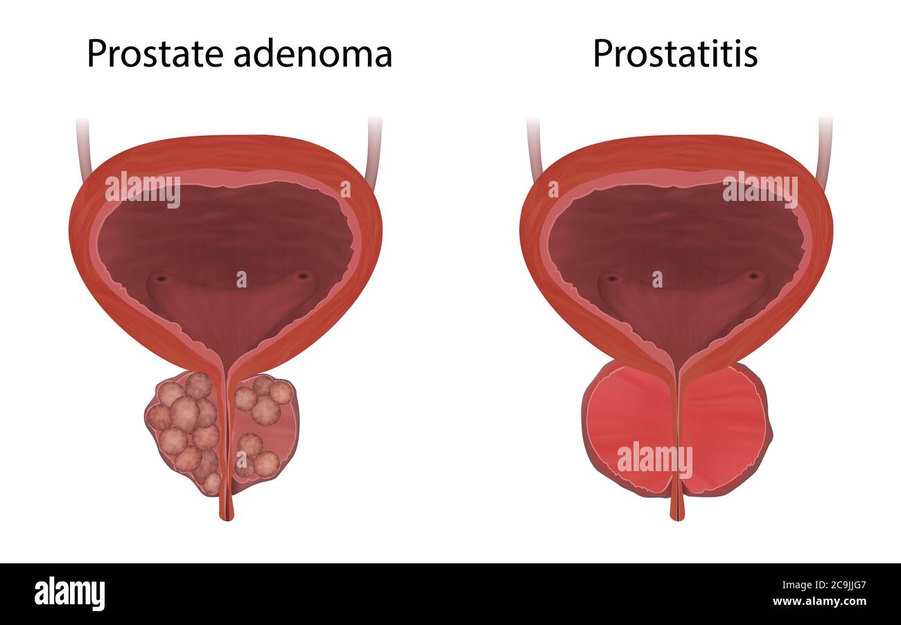 Comparison of prostate adenoma and prostatitis, illustration ...