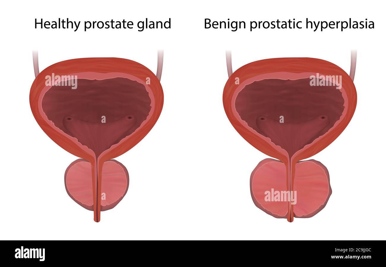 Comparison of benign prostatic hyperplasia and a healthy prostate gland, illustration. Benign ...