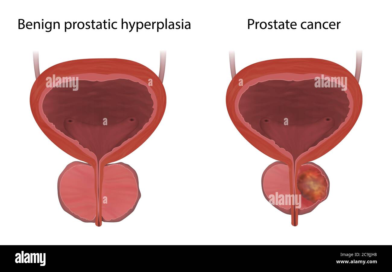 Comparison of benign prostatic hyperplasia and prostate cancer ...