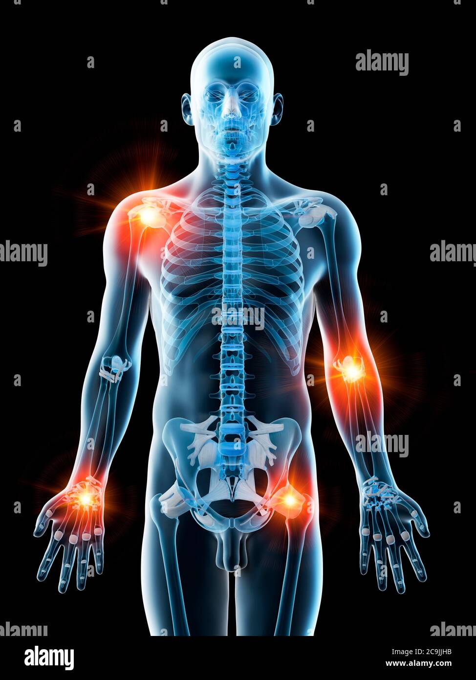 Joint pain, conceptual computer illustration Stock Photo - Alamy