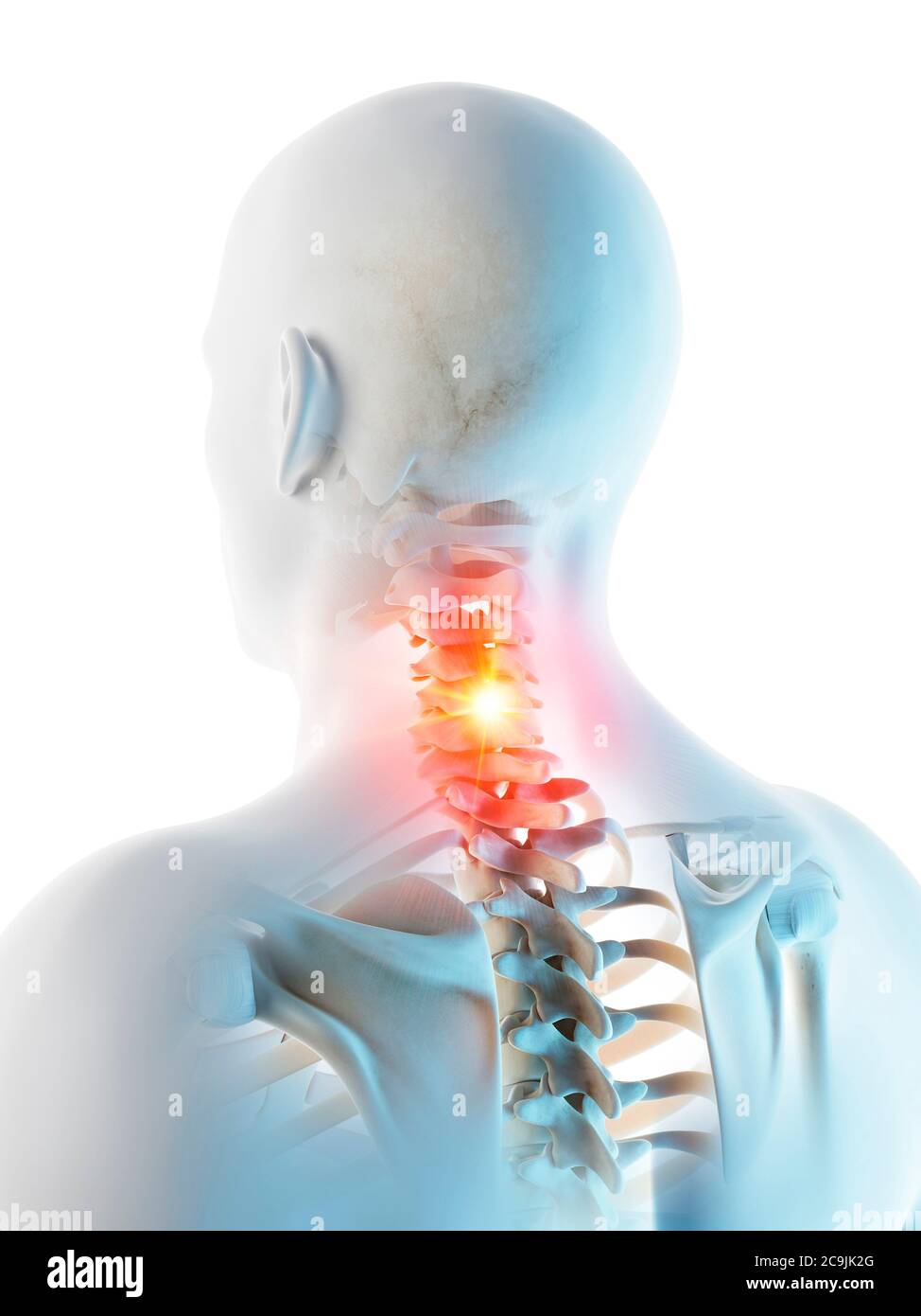 Neck pain, conceptual computer illustration Stock Photo - Alamy