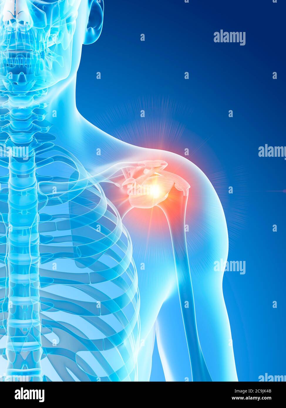 Shoulder pain, conceptual computer illustration Stock Photo - Alamy