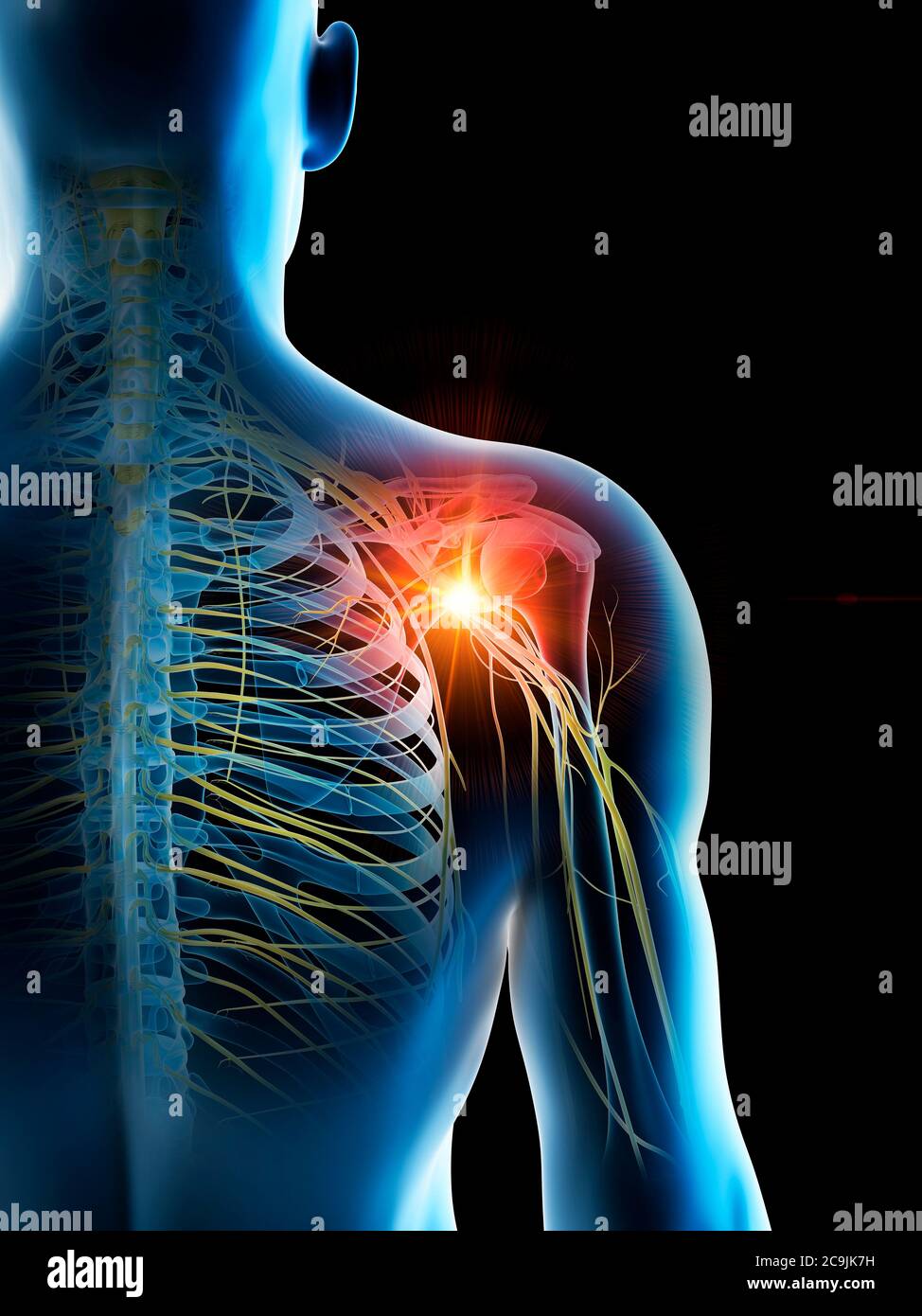 Shoulder pain, conceptual computer illustration Stock Photo - Alamy