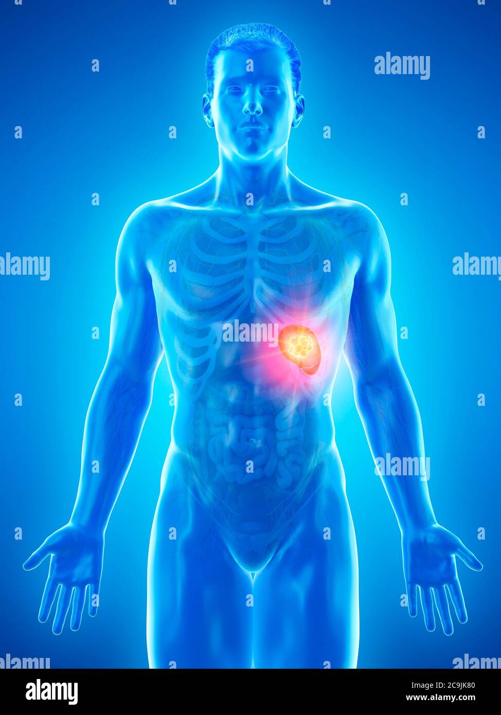Spleen cancer, conceptual computer illustration Stock Photo - Alamy
