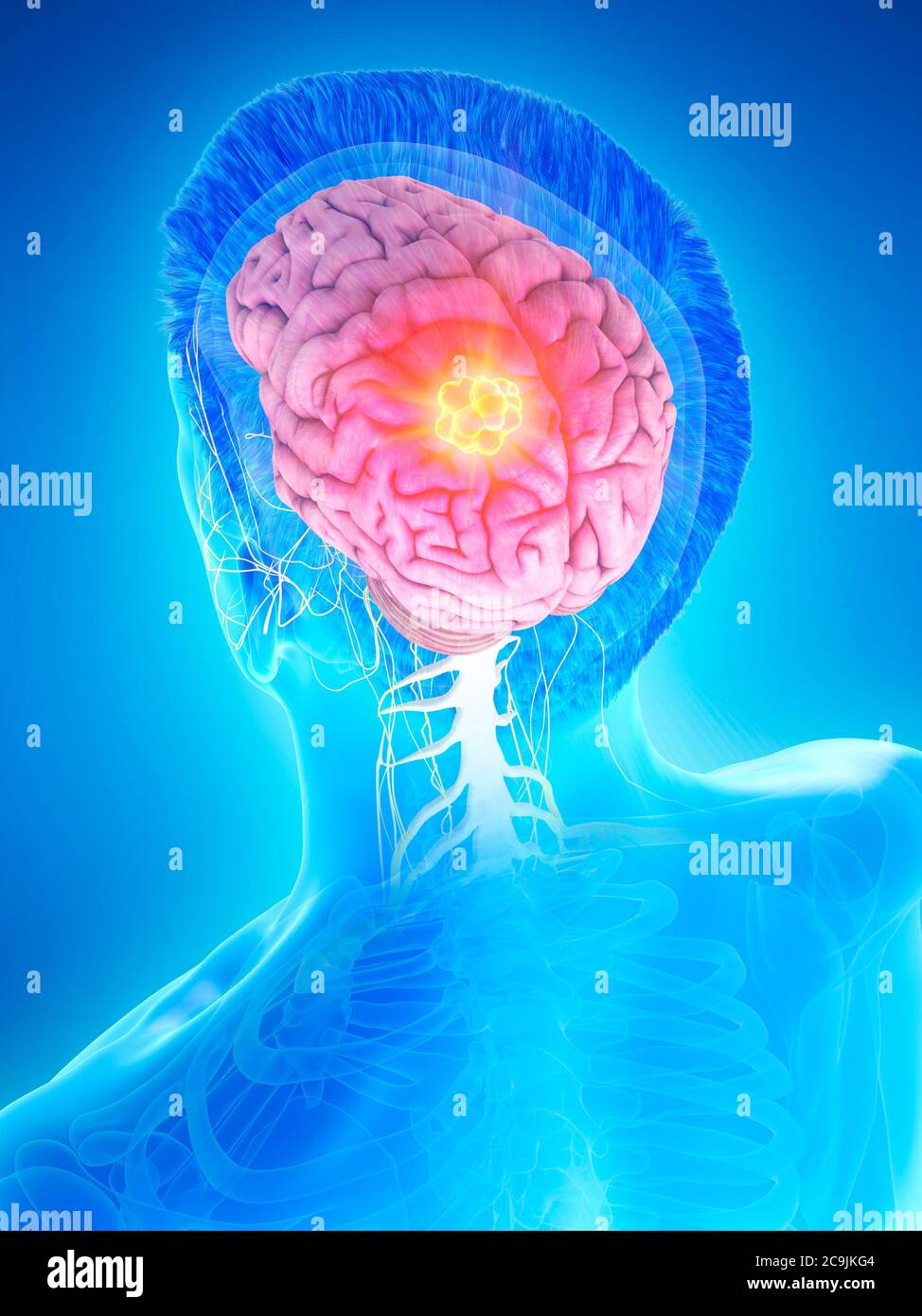 Brain tumour, conceptual computer illustration Stock Photo - Alamy