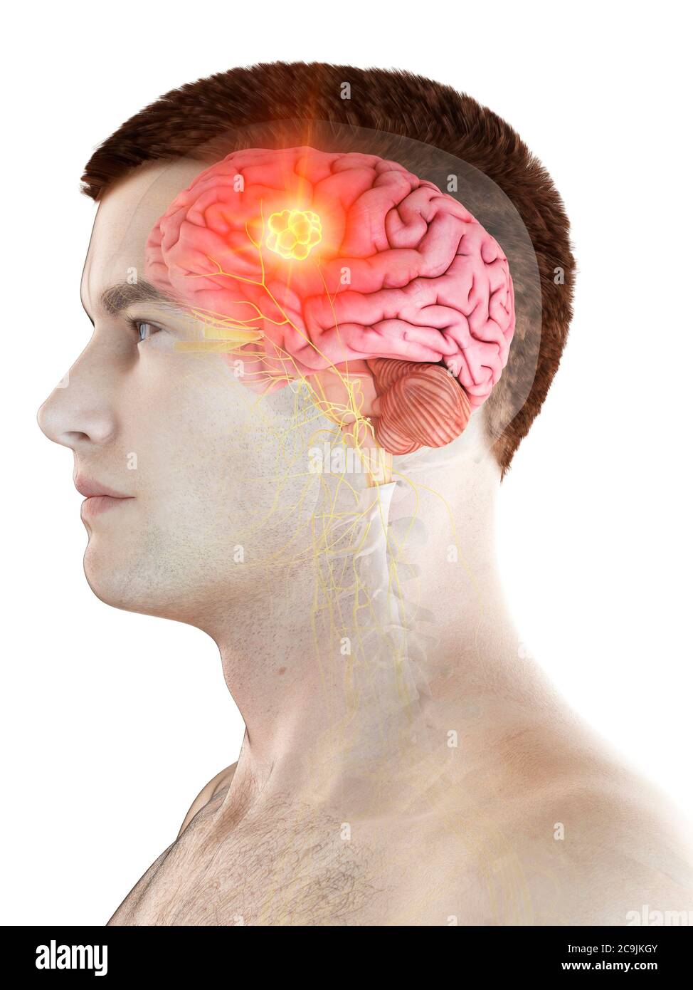 Brain tumour, conceptual computer illustration Stock Photo - Alamy