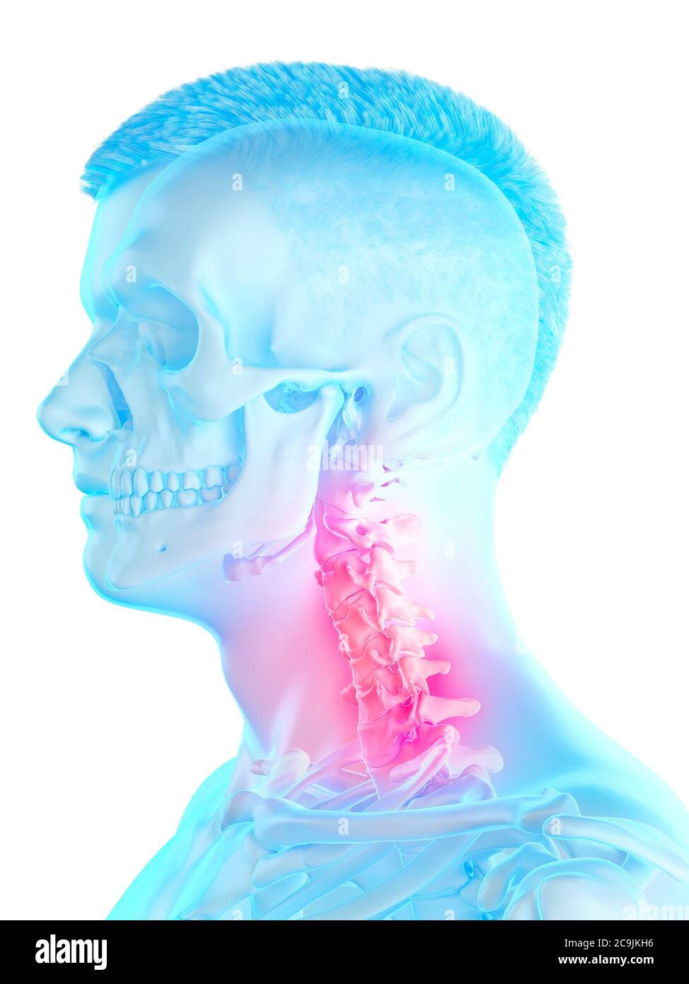 Neck pain, conceptual computer illustration Stock Photo - Alamy