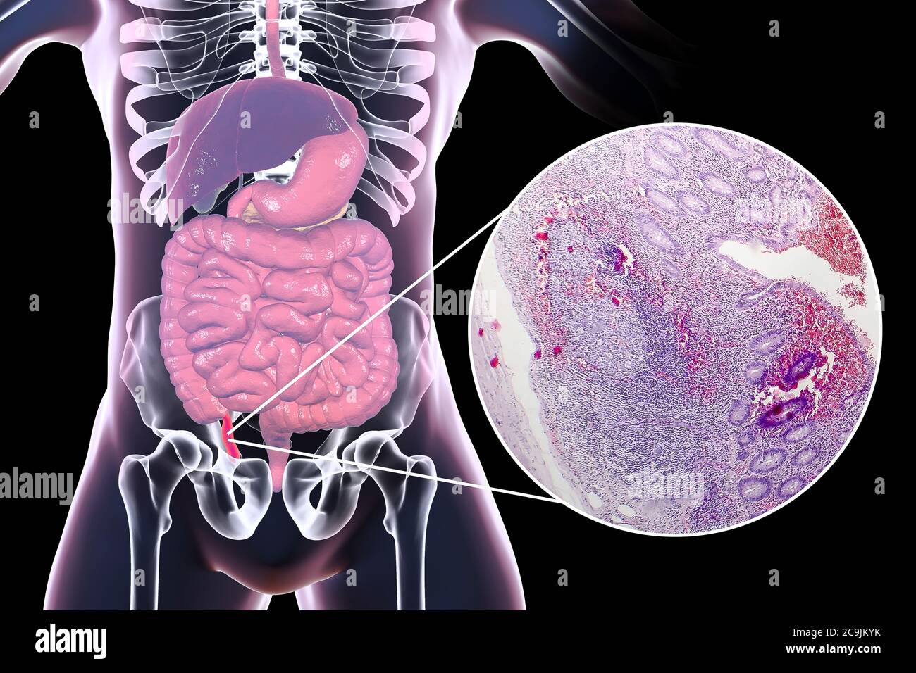 Chronic appendicitis, computer illustration and light micrograph ...