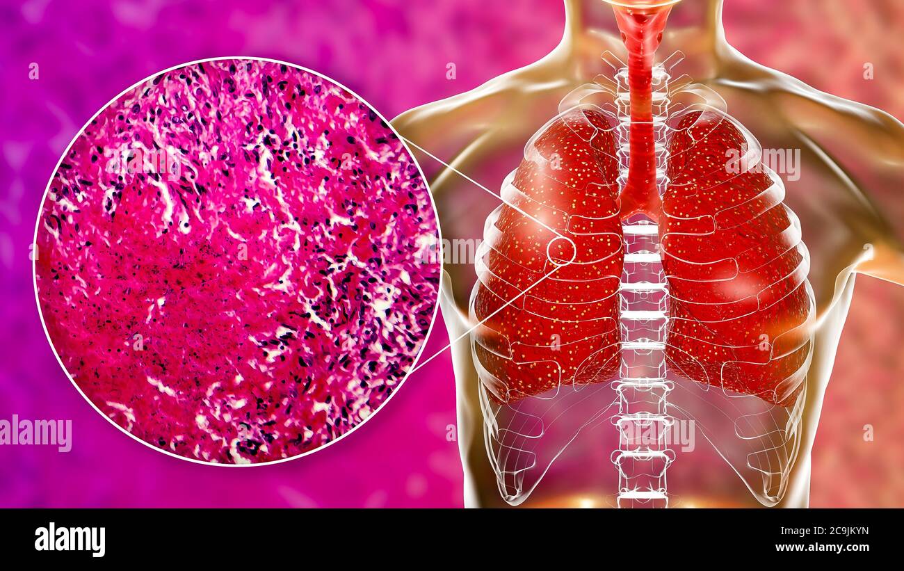 Miliary Tuberculosis Skin