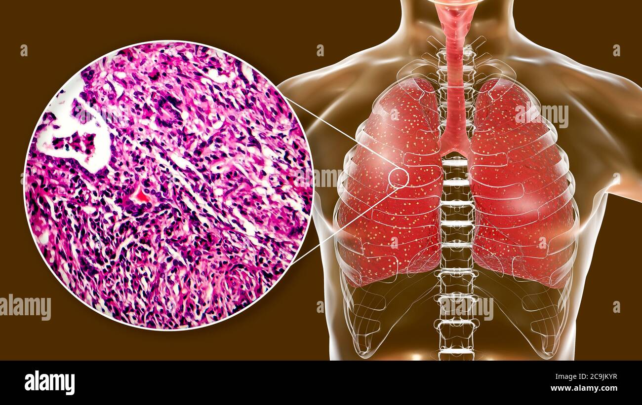 Miliary Tuberculosis